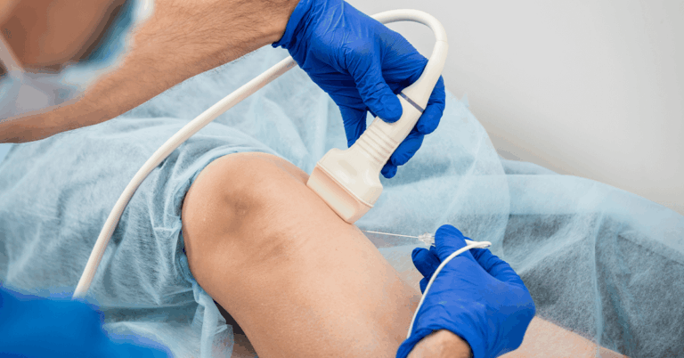 Radiofrequency Ablation (RFA): How Long Does Pain Relief Last?